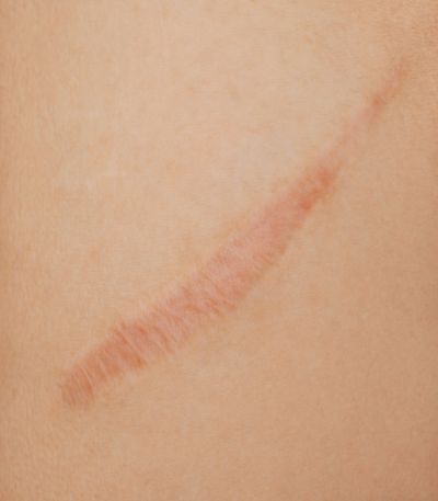 Learn About Pilonidal Cyst Excision Recovery | Dr. Allen Kamrava
